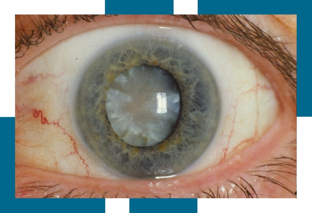 Cataract Research Organization | National Foundation for Eye Research